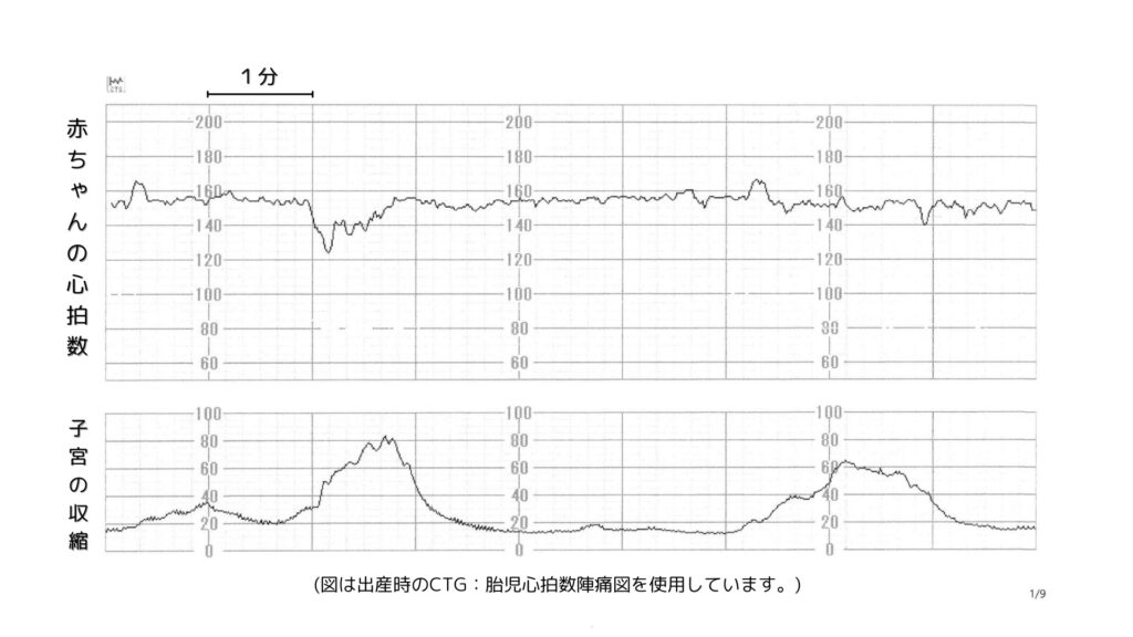 NST（ノンストレステスト）とは？グラフの見方を解説！ - 産科医療LABO