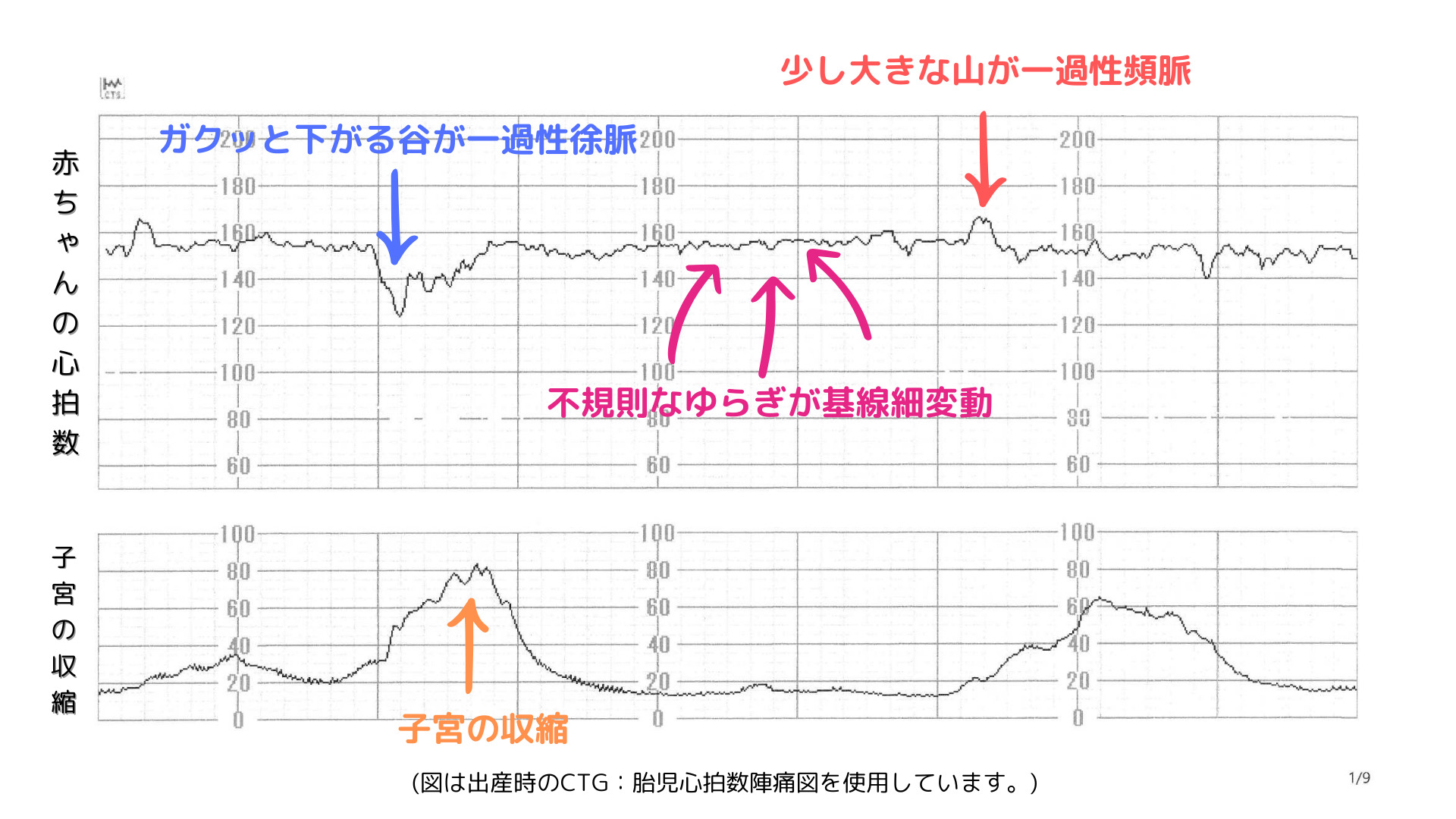 NST（ノンストレステスト）とは？グラフの見方を解説！ - 産科医療LABO